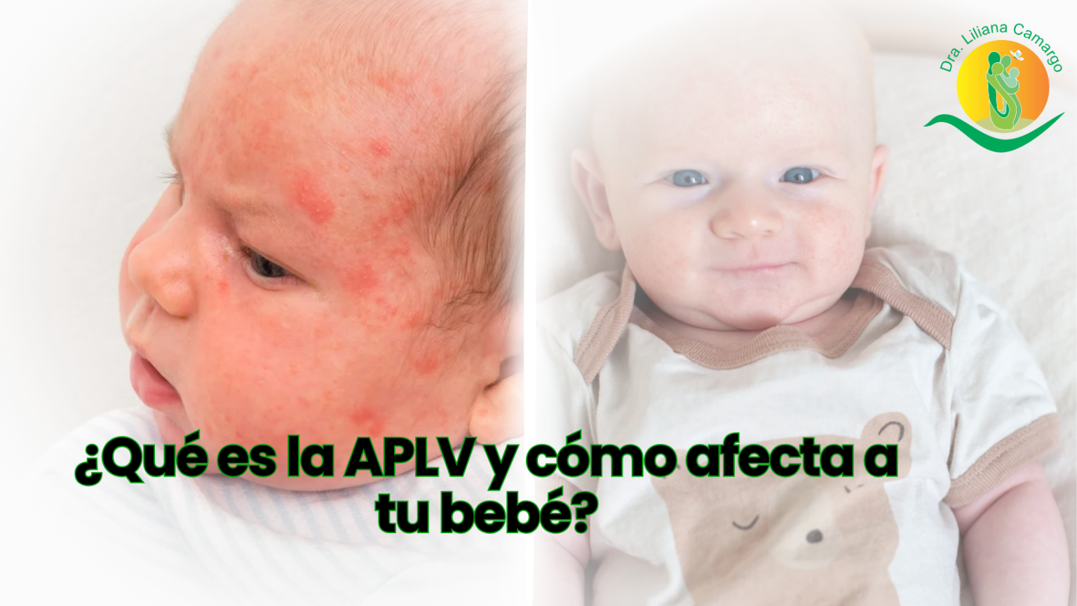 ¿Qué es la APLV y cómo afecta a tú bebé?
